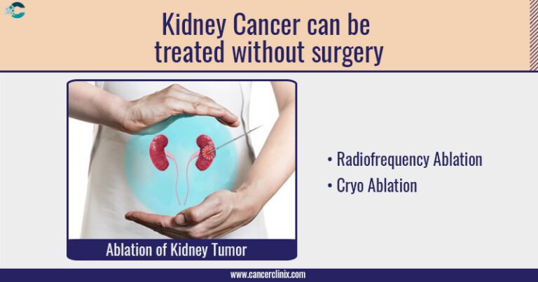 Robotic Kidney Cancer Surgery & Non-Surgical treatment for Kidney ...