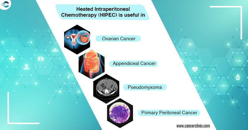 For Peritoneal Cancer, meet HIPEC specialist in Ahmedabad - Cancerclinix