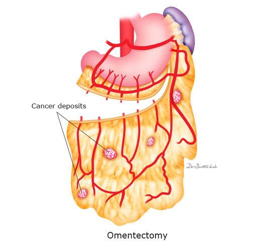 Best Ovarian Cancer Treatment in Ahmedabad - Dr. Swati Shah